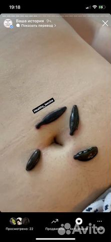 Пиявки медицинские